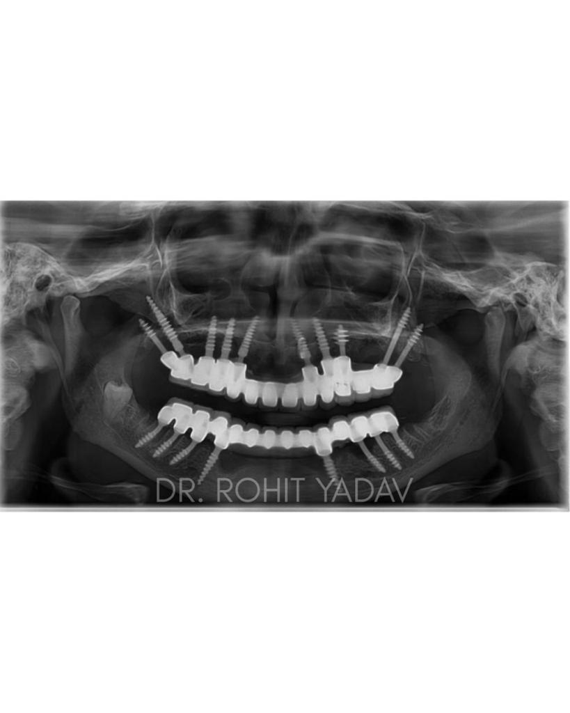 Opt For Complete Mouth Dental Implants Over Conventional Dentures